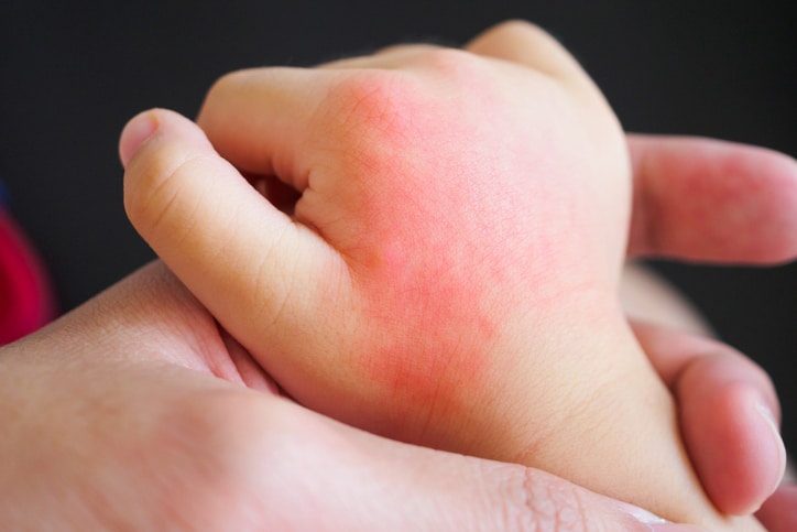 3 Most Common Allergic Reactions in Kids | KidsStreet