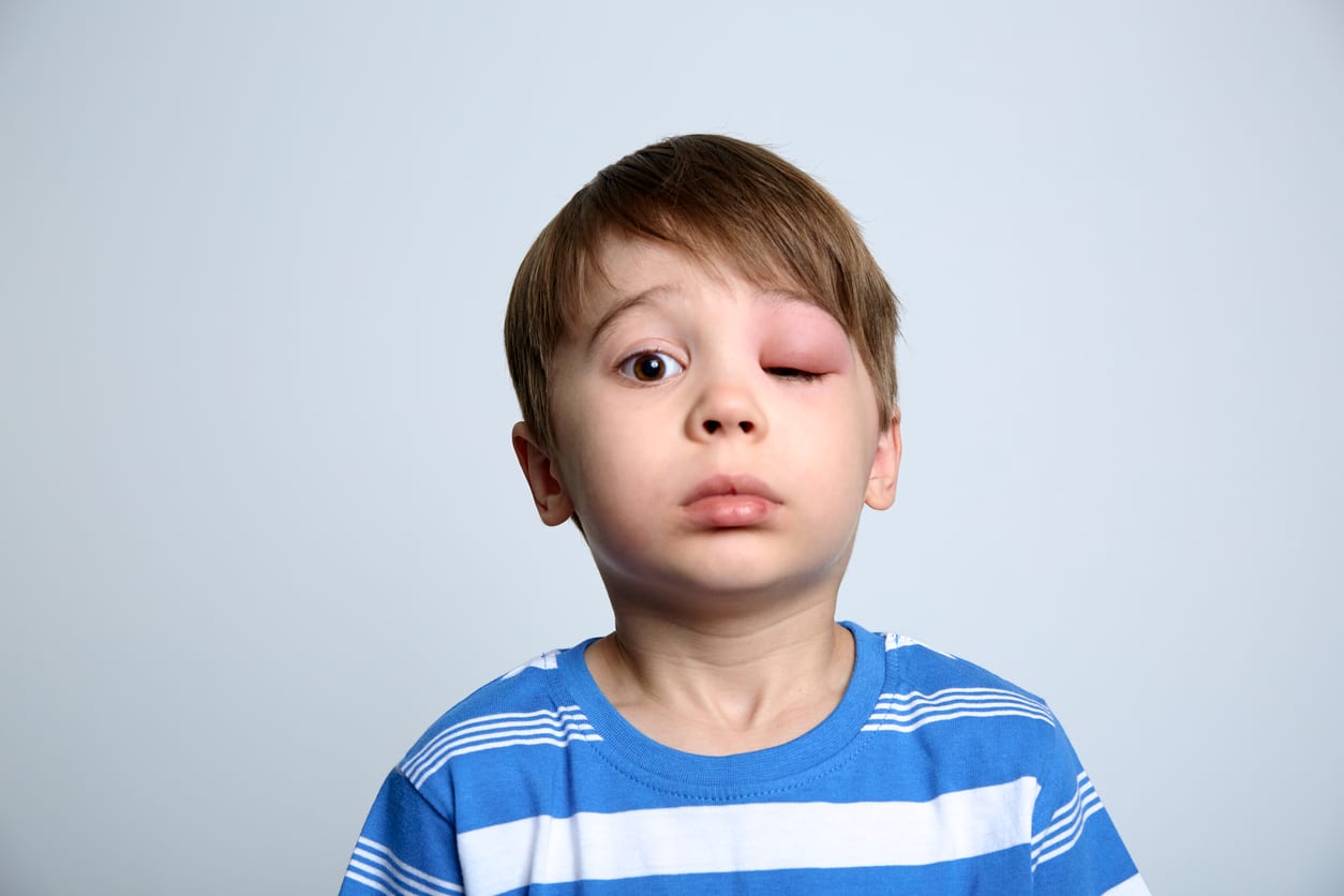 Eye Injuries in Kids | KidsStreet Urgent Care for Children
